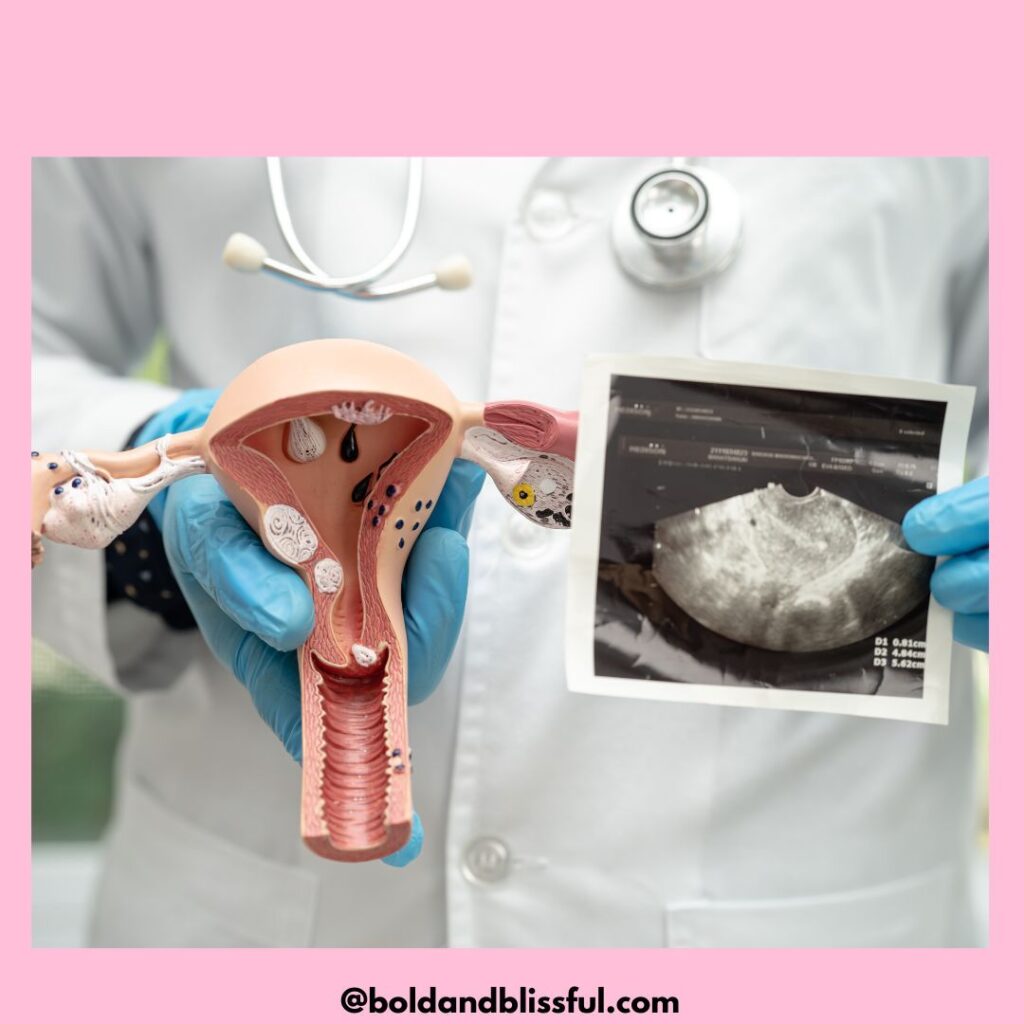 Everything you need to know about PCOS (polycystic ovary syndrome ...